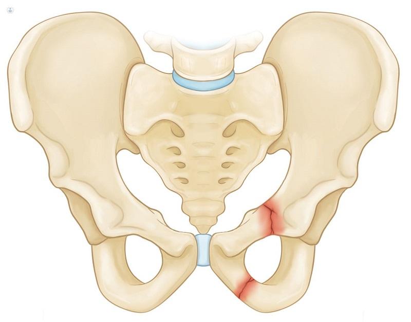Fractura De Pelvis Qu Es S ntomas Y Tratamiento Top Doctors